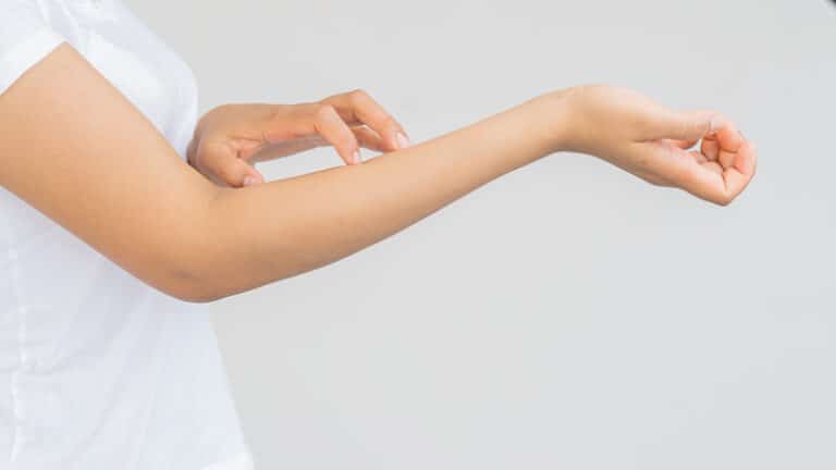 Orticaria da stress: cos'è, sintomi, cause e cura - Anna Rossoni