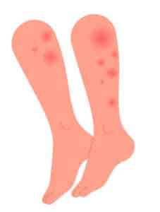 Orticaria da stress: cos'è, sintomi, cause e cura - Anna Rossoni